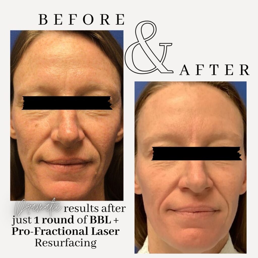 Profractional Therapy for Skin Renewal | Paul Rottler, MD